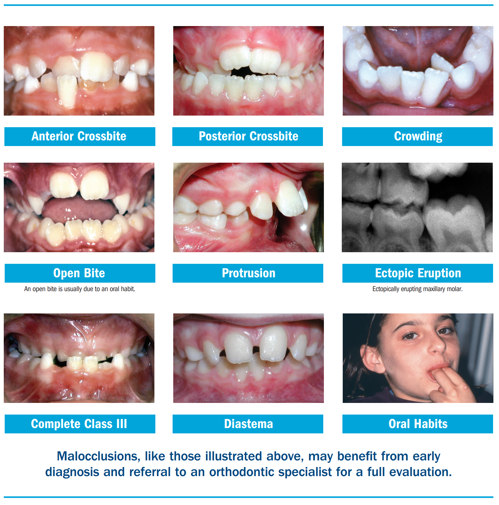Two-Phase Treatment - Fusion Dental & Braces